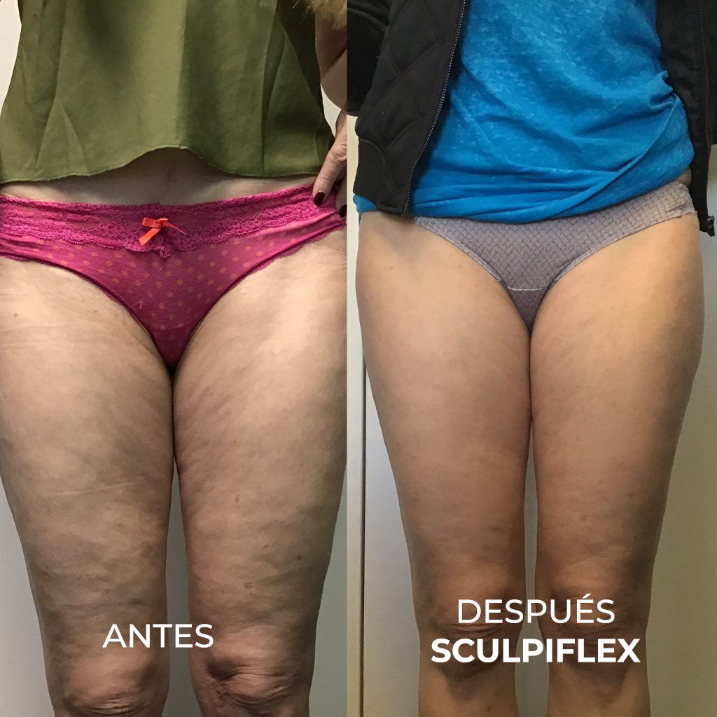 Sculpiflex Funnel Spanish